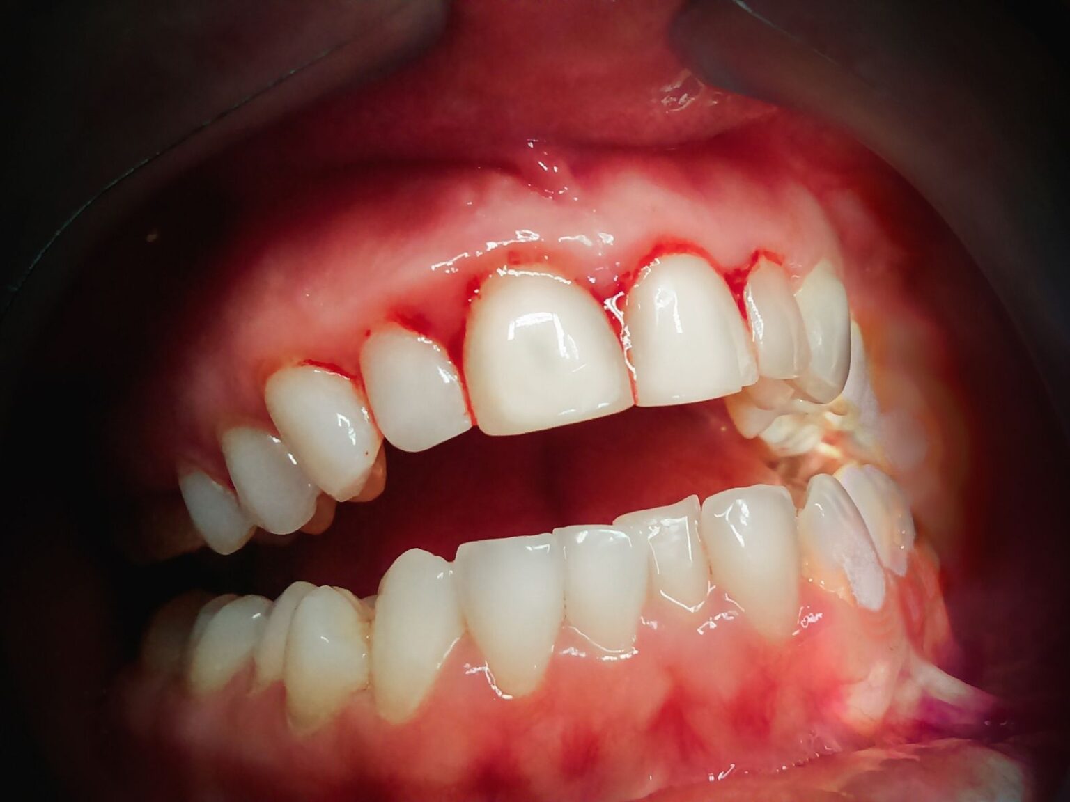 Explore causes of bleeding gums with Callalen Dentist TX